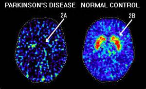 DAT Scan: Can it Really Tell Me I have PD? : By Dr. De Leon ...